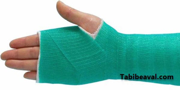 گچ گیری و آتل گیری در منزل طبیب اول گچ گیری و آتل گیری با ساده ترین روش